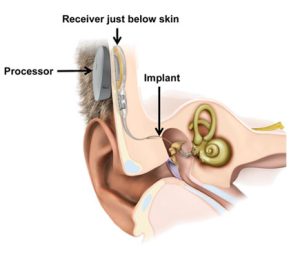 Cochlear Implants & Other Implantable Devices - Hearing Loss ...
