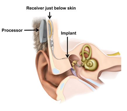 Cochlear Implants & Other Implantable Devices - Hearing Loss ...